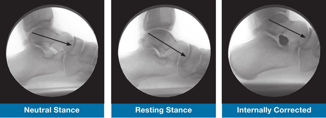 HyProCure Surgery for Flat Feet - Sydney Podiatric Surgeon